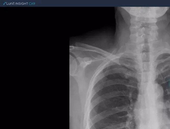 Fujifilm introduce AI-powered chest x-ray product with Lunit | AI Magazine