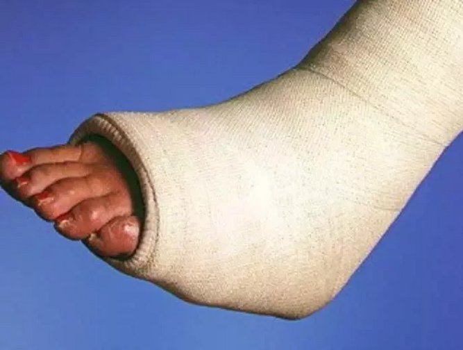 Plaster casts could be phased out by new technique | Healthcare Digital